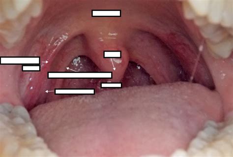 Anatomic Landmarks Of Oral Cavity Dorsal Tongue View Of Uvula And
