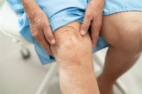 Asian Elderly Woman Patient Show Her Scars Surgical Total Knee Joint