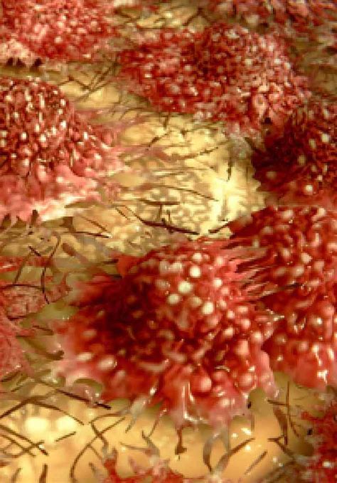 Clinical And Molecular Biology Of Angiosarcoma Intechopen