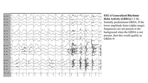 ACNS Standardized Critical Care EEG Terminology 2021 PDF