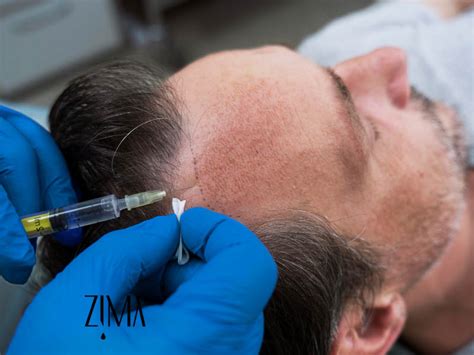 کاشت مو انواع روش، عوارض، مزایا و معایب سوالات پرتکرار زیمالب