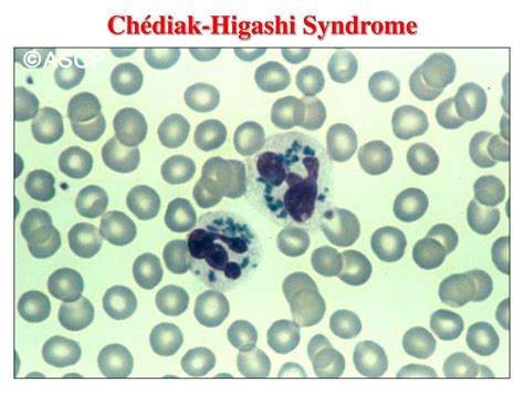 Ppt Disorders Of Granulocyte Number And Function Powerpoint