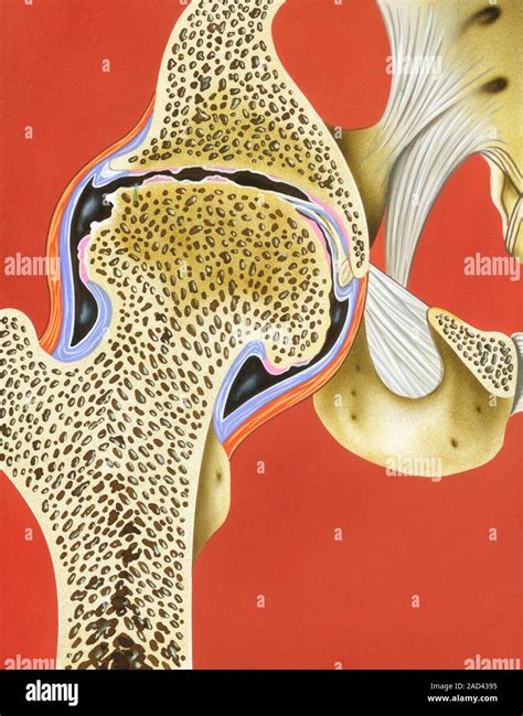 Hip Joint Pannus Formation Illustration Showing Pannus Formation