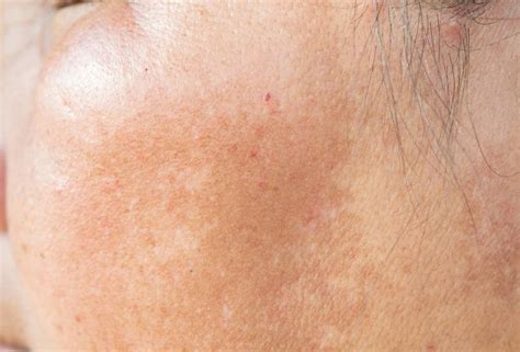 Пигментные пятна на лице как избавиться причины лечение пигментации