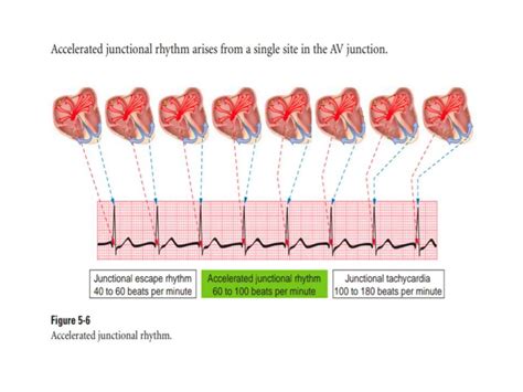 JUNCTIONAL DYSRHYTHMIAS AND HOW TO INTERPRET IN ECG PPTX