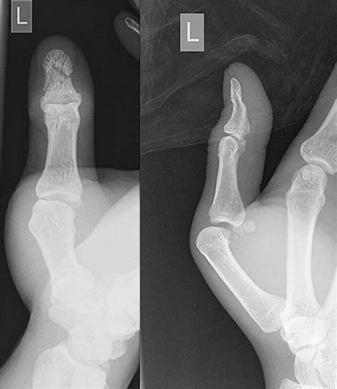 Anteroposterior And Lateral X Rays Of The Left Thumb Showing Volar