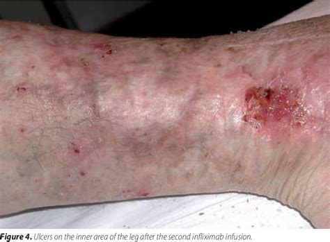Figure 4 From Pyoderma Gangrenosum Associated With Ulcerative Colitis Treated With Infliximab