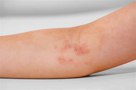 New And Emerging Treatments For Atopic Dermatitis