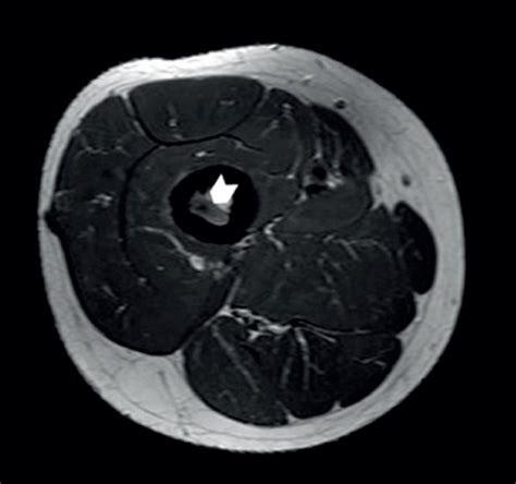 Axial Ct Scan A At Six Months Post Rfa Depicting The Formation Of