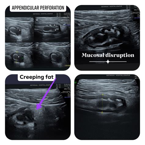 A Perforated Appendix Is One Of Drhari Ramradiology