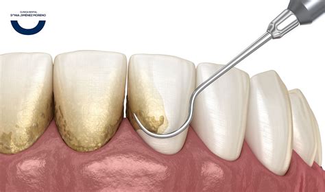 ¿el Curetaje Dental Es Peligroso Todo Lo Que Necesitas Saber