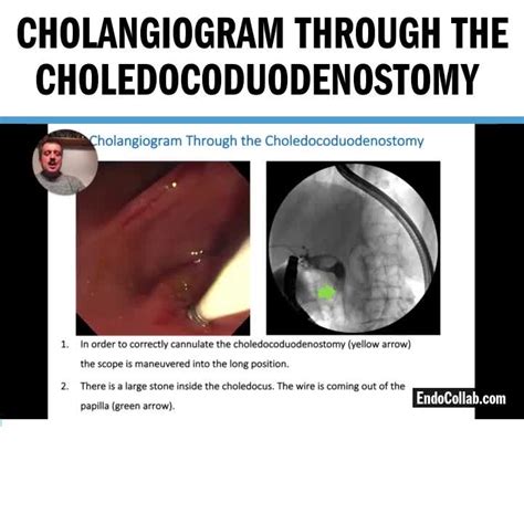 Klaus Mönkemüller On Linkedin Want To Make Ercp With A Long Position Choledochoduodenostomy…