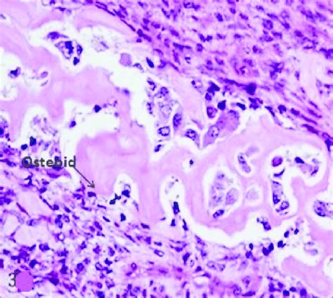 Photomicrograph Showing Extensive Areas Of Osteoid Formation Lined By Download Scientific