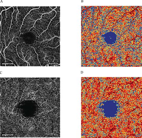 A Optical Coherence Tomography Angiography Image Of The Superficial Download Scientific