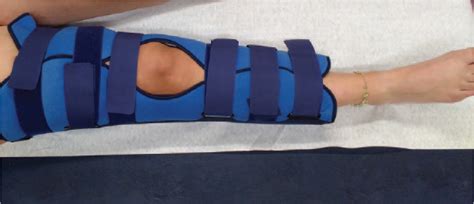 Plaster Splint Brace Tape Or Functional Mobilization After First
