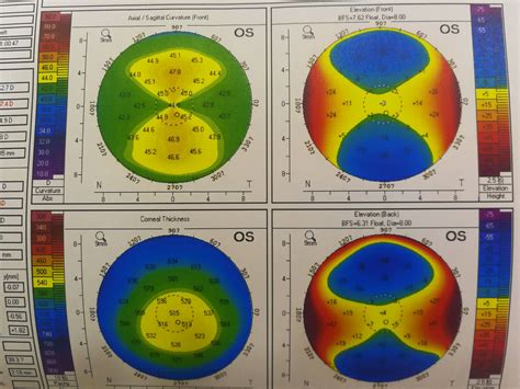 角膜厚度正常值角膜厚度角膜第3页大山谷图库