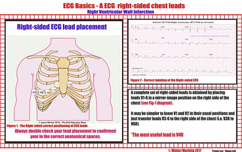 ECG Educator Blog