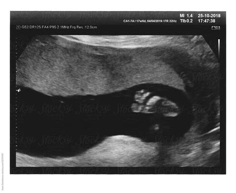 17 Weeks Pregnant Ultrasound