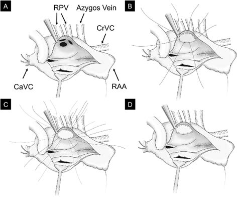 Diagrammatic Representation Of The Procedure For Closure Of Sinus