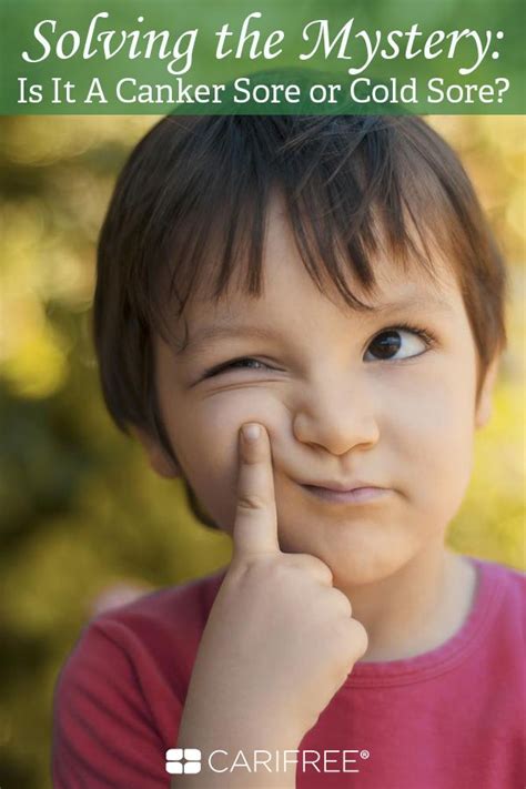 Solving The Mystery Is It A Canker Sore Or Cold Sore Artofit