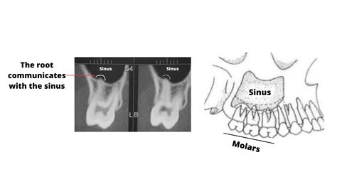 Tooth Extraction And Sinus Repair At Margaret Rakes Blog
