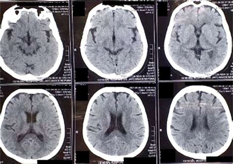 Normal Non Contrast Ct Of Brain On Admission Download Scientific Diagram