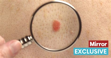 Skin Cancer Breakthrough As Ai That Spots Cases In Seconds To Be Rolled