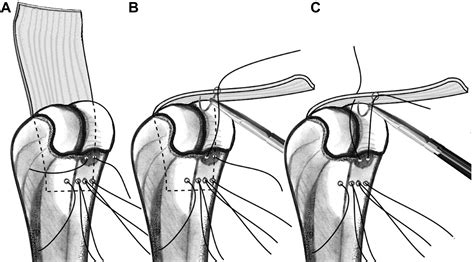 Interposition Arthroplasty And Bidirectional Stabilization Of The Elbow