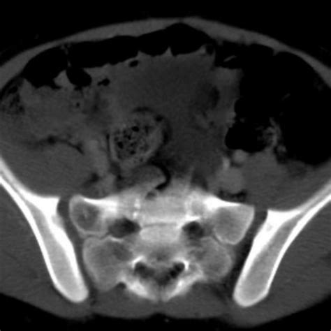Sacral Osteomyelitis Associated With Pyogenic Sacroiliitis Eurorad