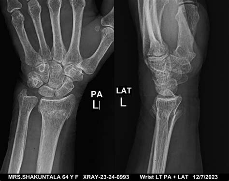 Wrist X Ray Hand Carpal Bone Metacarpal Bone Radiology Image Radiography 2d Image