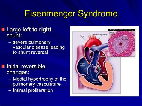 What Is Eisenmengers Syndrome At Kristy Breeden Blog