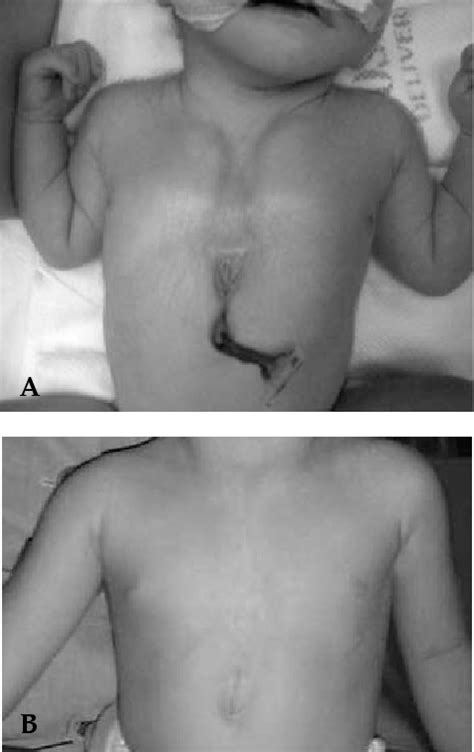 Figure 1 From Complete Sternal Cleft In A Filipino Newborn Semantic Scholar