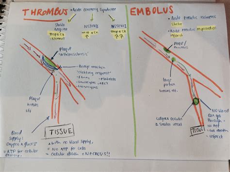 Perbedaan Antara Trombosis Dan Emboli