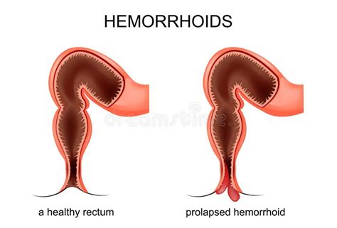 Partial Rectal Prolapse