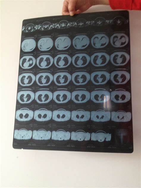 正常肺部ct影像正常人正常人肺部ct 伤感说说吧