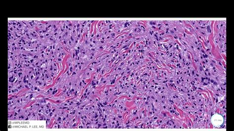 Juvenile Xanthogranuloma Histology