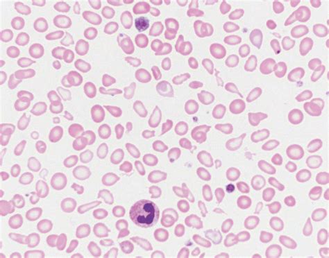 Peripheral Smear The Red Blood Cells Are Hypochromic And Microcytic