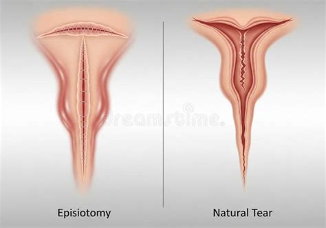 Medical Illustration Comparing Episiotomy And Natural Tear Left Side