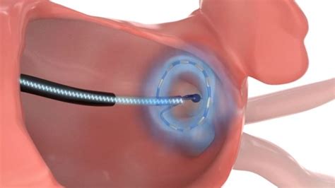 Pulsed Field Ablation A New Hope For Afib Patients