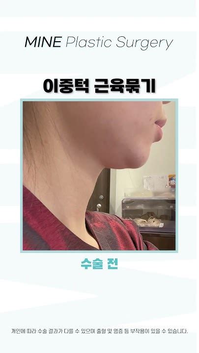 동그란 얼굴 이젠 스트레스 안받아요 이중턱 근육묶기 리얼후기 Shorts Youtube