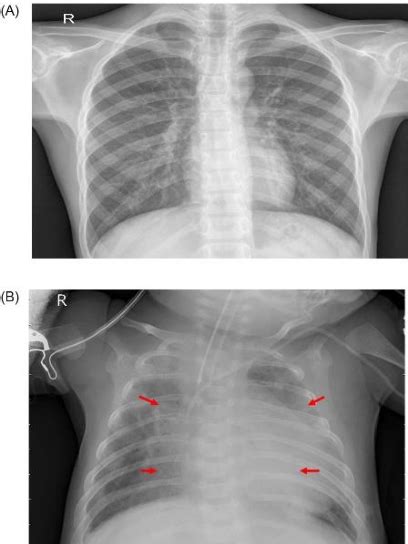 Figure 1 From Comparative Analysis And Validation For Diagnosis Of Pneumonia Through Chest X