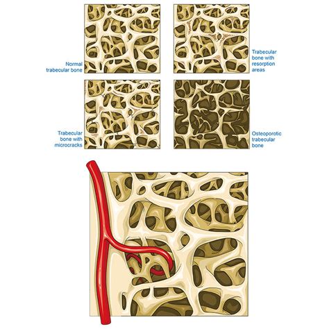Trabecular Bone Vector