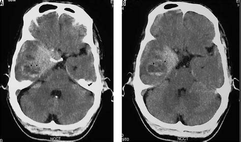 Imaging Spectrum Of Meningiomas A Review Of Uncommon Imaging