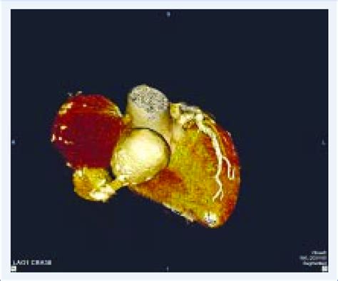 Three Dimensional Heart Reconstruction Clearly Visible Are Two Right Download Scientific