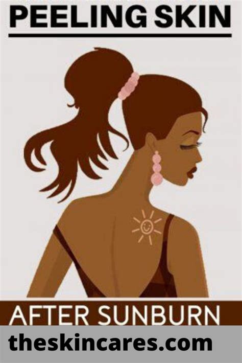 Skin Peeling Issue After Sunburn Peeling Skin Skin Natural Remedies