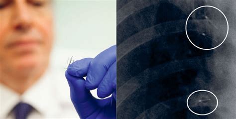 Pulmonary Critical Care And Sleep Medicine Mount Sinai New York