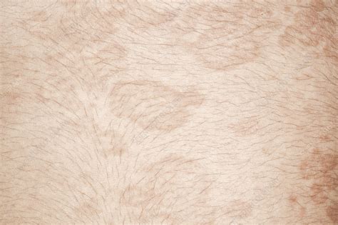 Pityriasis Rosea Rash Stock Image C058 1259 Science Photo Library