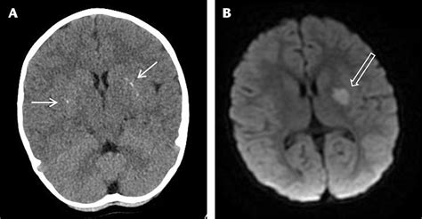 A Case Of Lenticulostriate Stroke Due To Minor Closed Head I