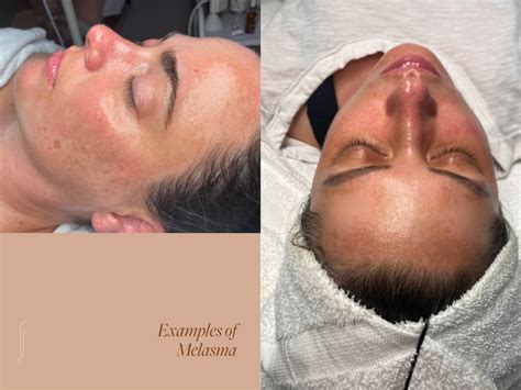 Understanding Melasma Symptoms Diagnosis And Management — Noelani