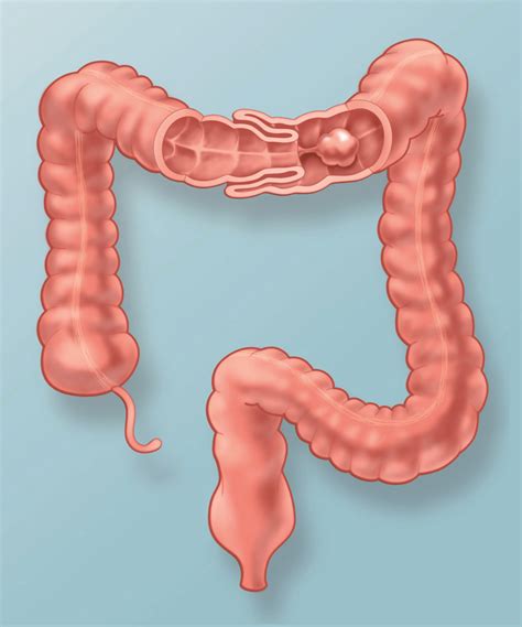 Colo Colonic Intussusception Nicholaslack